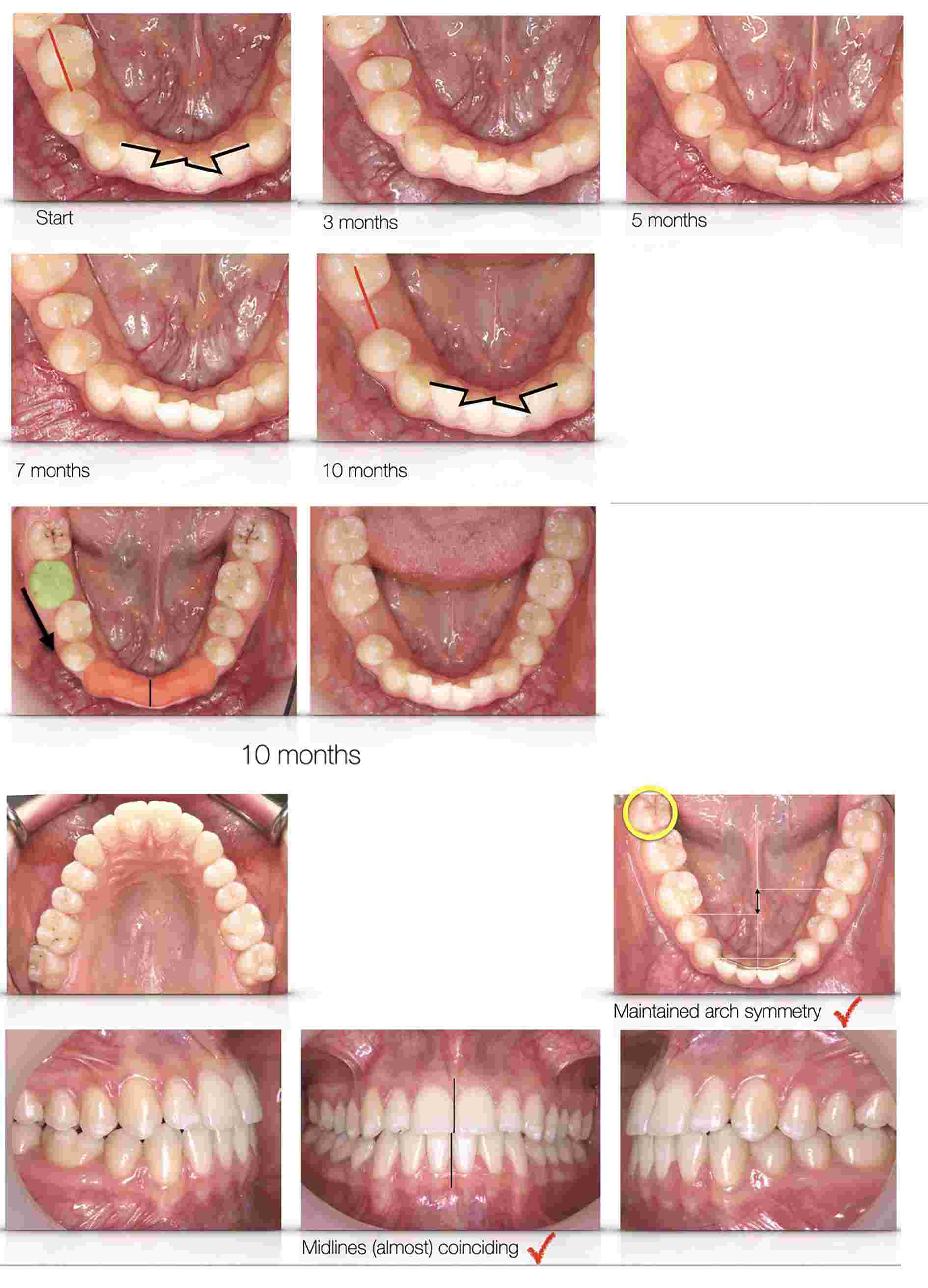 A Point-Counterpoint discussion on Hemisection for mandibular primary ...